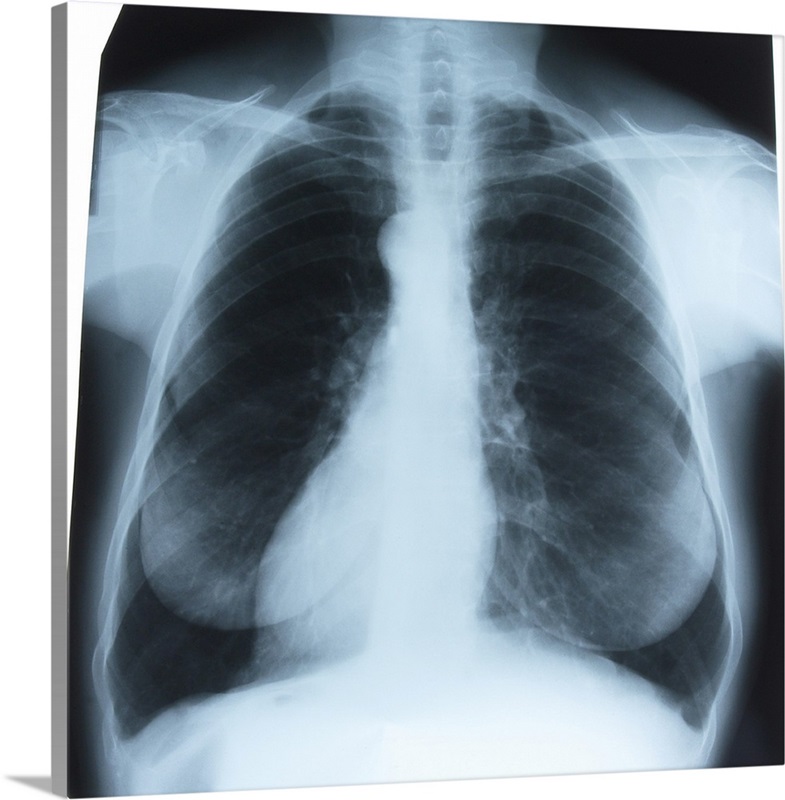 Chest x-ray | Great Big Canvas