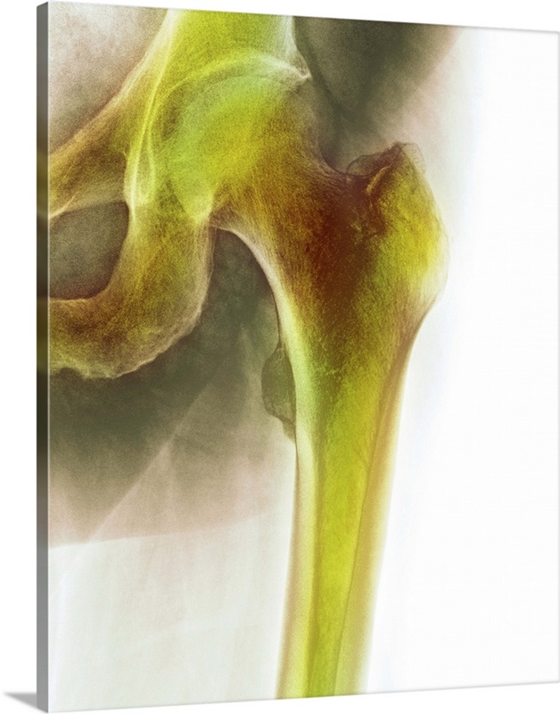 Normal hip, X-ray | Great Big Canvas
