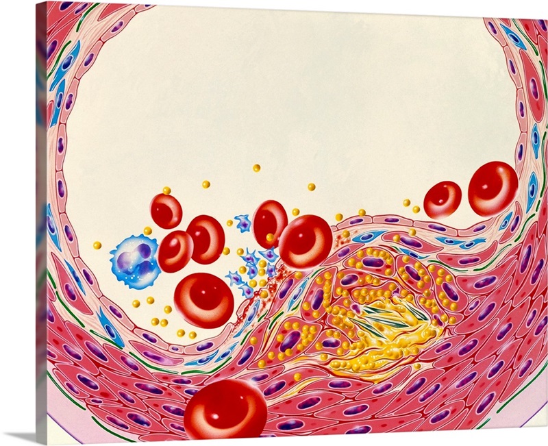 Artwork of artery narrowed by atherosclerosis | Great Big Canvas