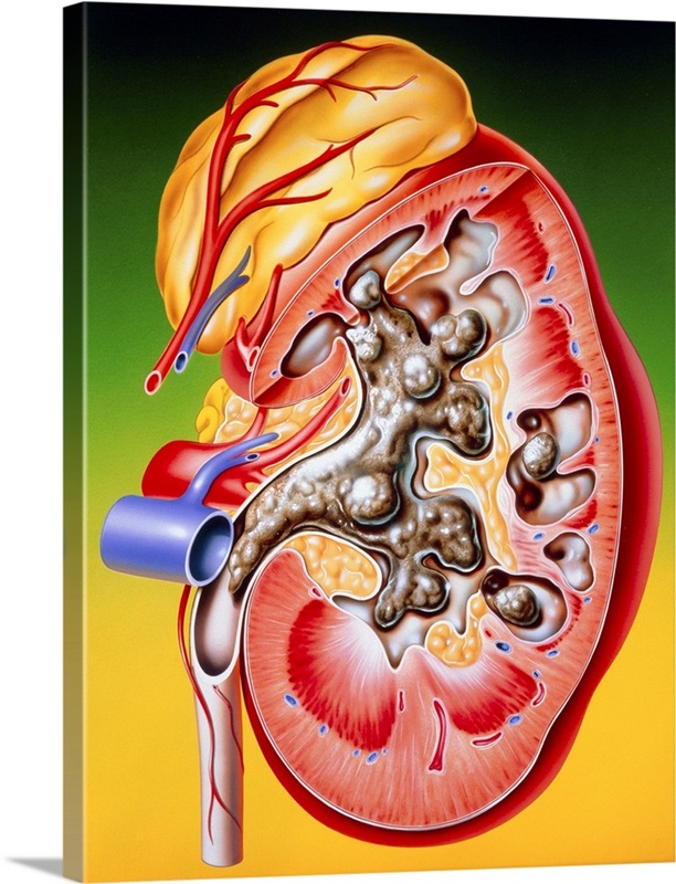 Illustration of a calculus or stone in the kidney | Great Big Canvas