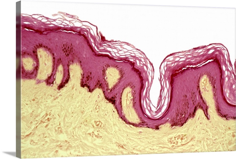 Skin pigmentation in Addison's disease | Great Big Canvas