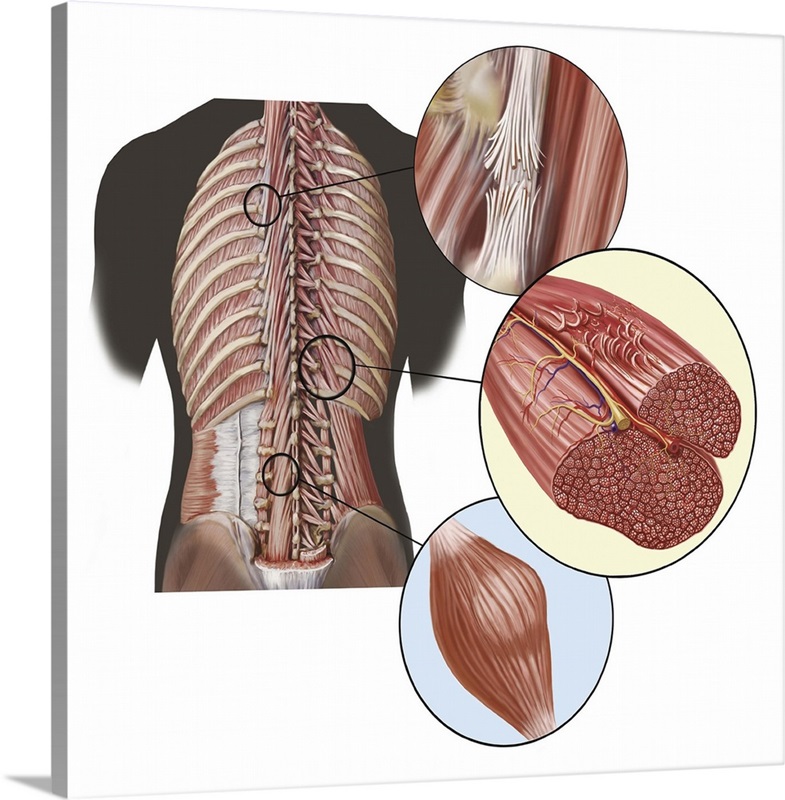 Detail of deep back muscles with a close-up of sprain, strain and spasm ...