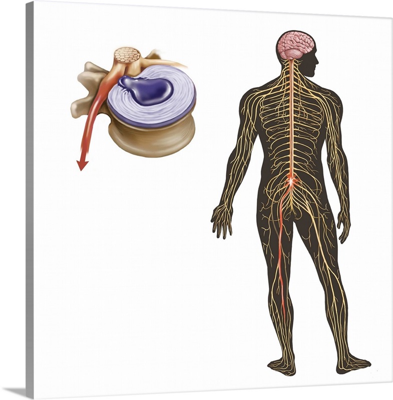 Sciatica caused from herniated disc | Great Big Canvas